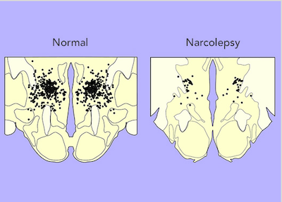 Narcolepsy Brain